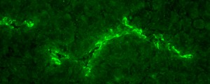 Sticky cells, blood vessels and cancer – the paradox of Claudin-14 ...