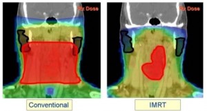 Sparking the radiotherapy revival - Cancer Research UK - Cancer News